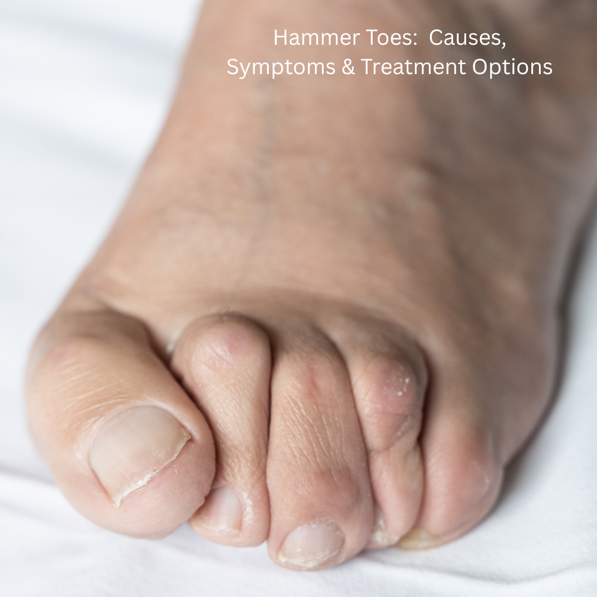 Hammer Toes: Causes, Symptoms and Treatment Options | The Foot Care Shop